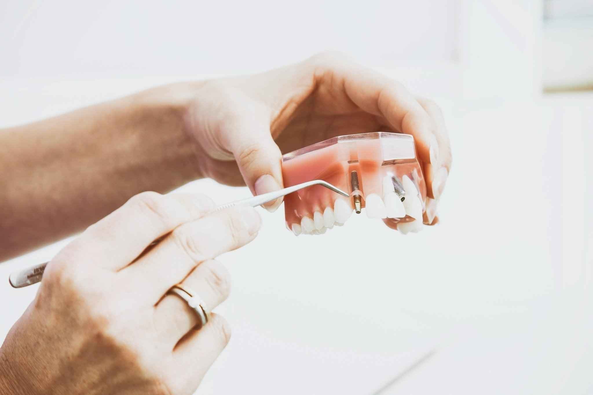 The Future of Smiles: Exploring Cutting-Edge Dental Prosthetic Technol ...