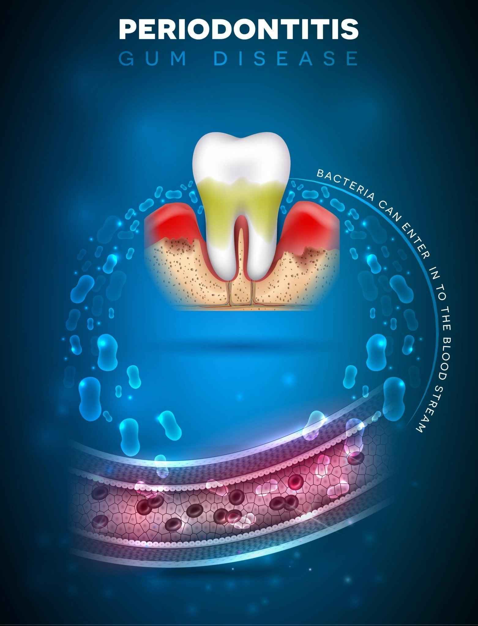 Exploring the Link Between Gum Disease and Diabetes – Dental Valution