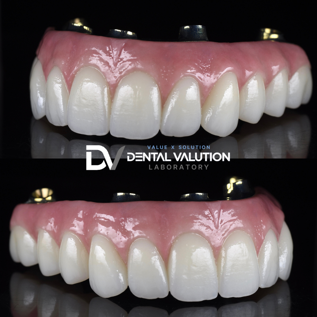 Exploring Full Arch Solutions for Optimal Patient Care – Dental Valution